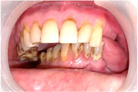 Prosthodontics And Crown & Bridge – SCB Dental College and Hospital ...